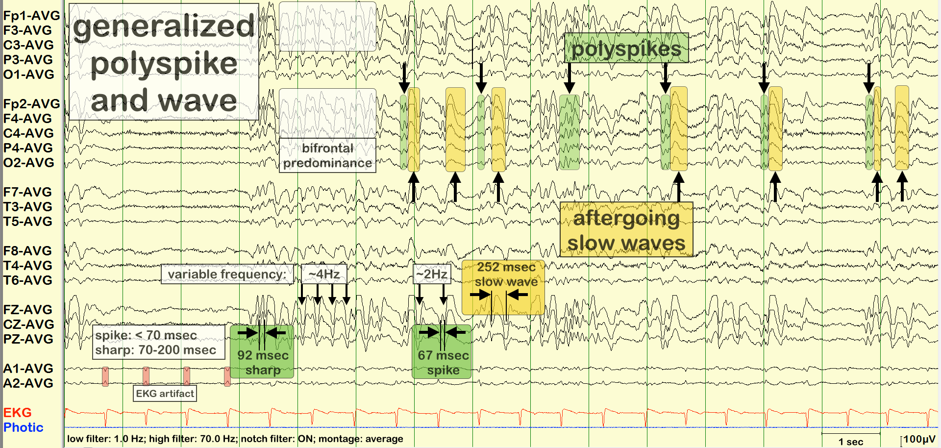 Poly Spike And Wave Poly Spike And Wave